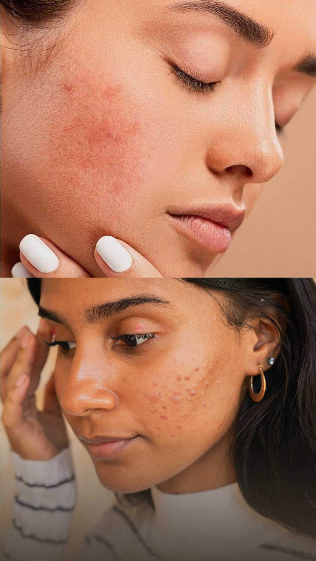 Acne vs Rosacea: how to tell the difference | Videos | Dr Derrick Phillips
